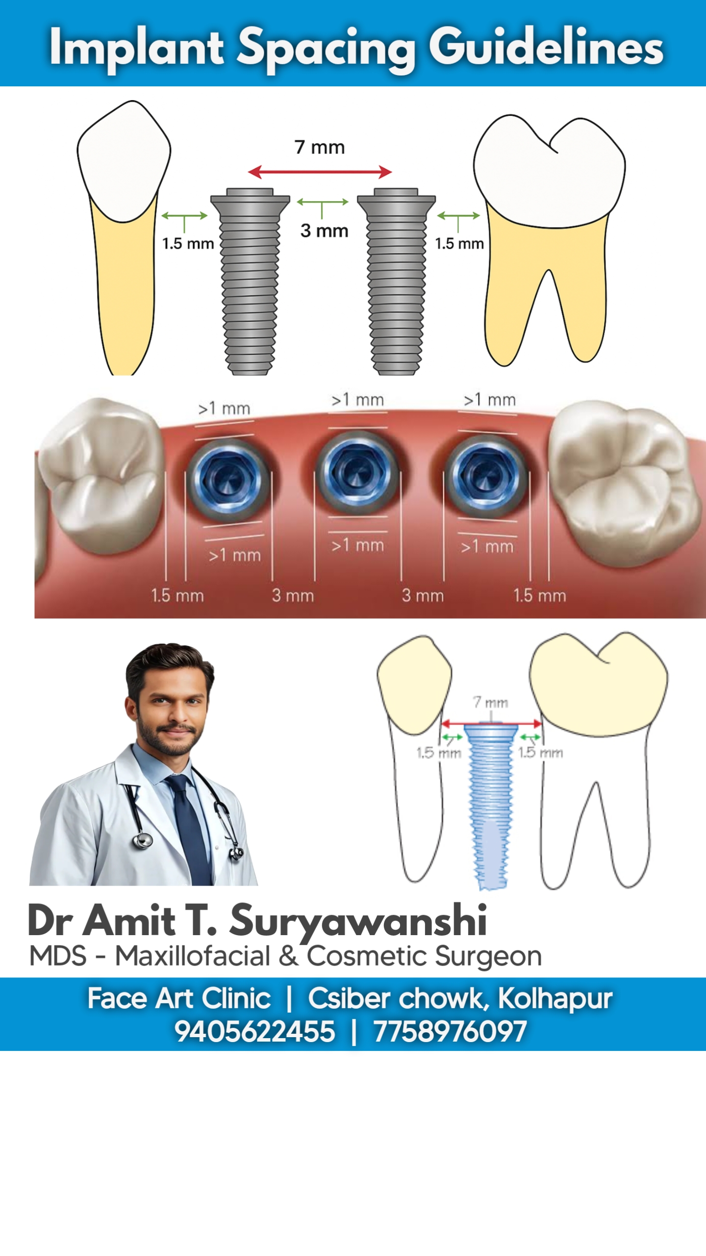 Dental Implant Guidelines - Face Art Clinic
